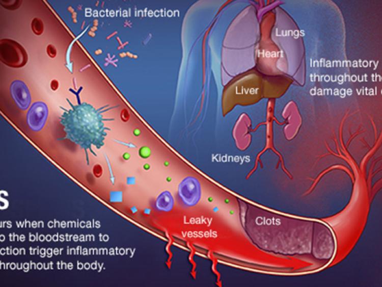 Have you asked? Could it be Sepsis? - Leitrim Observer